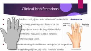 Osteoarthritis.pptx