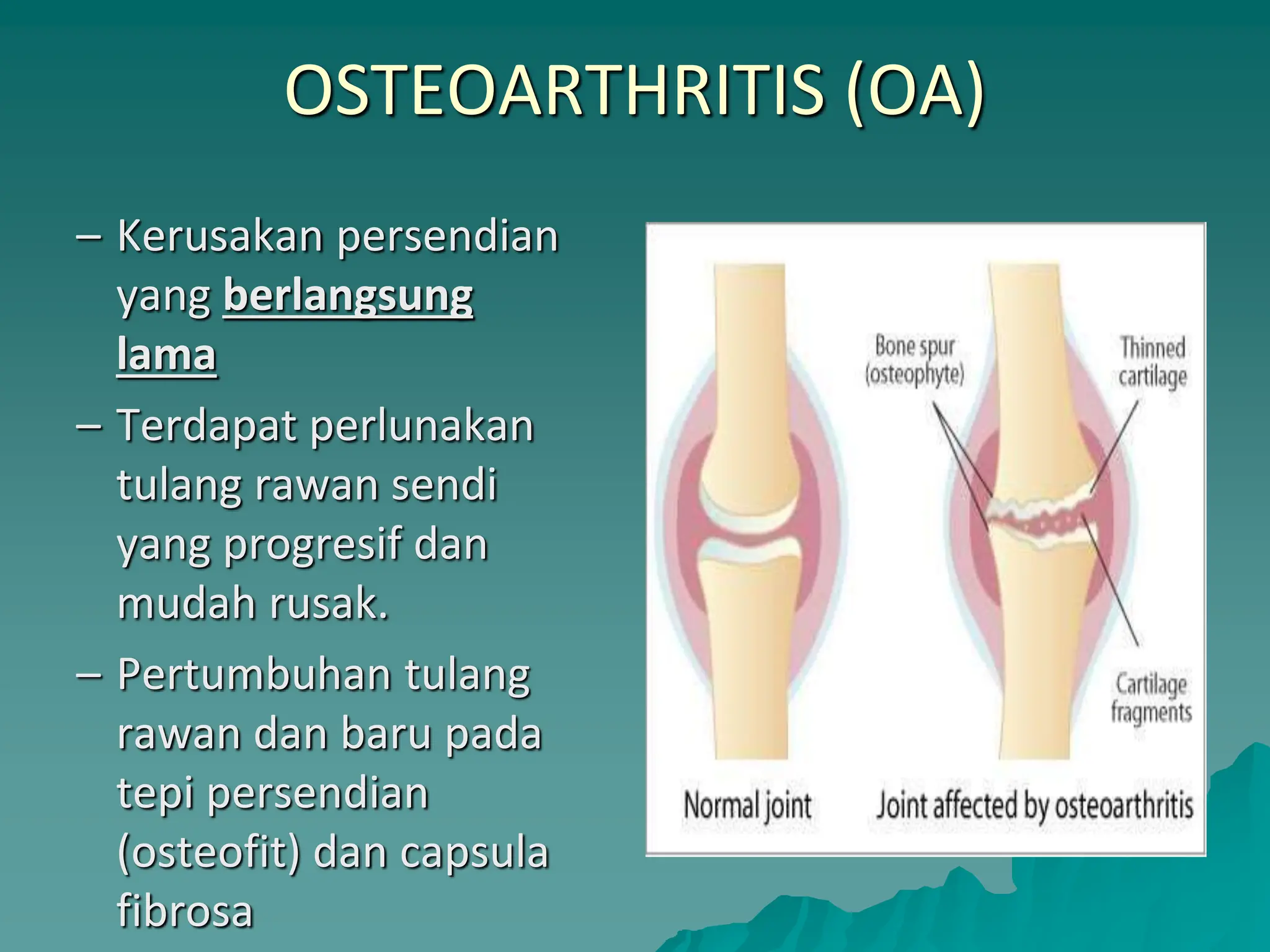 OSTEOARTHRITIS.pptx