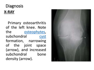 Osteoarthritis with mechanism, pathology and treatment | PPT