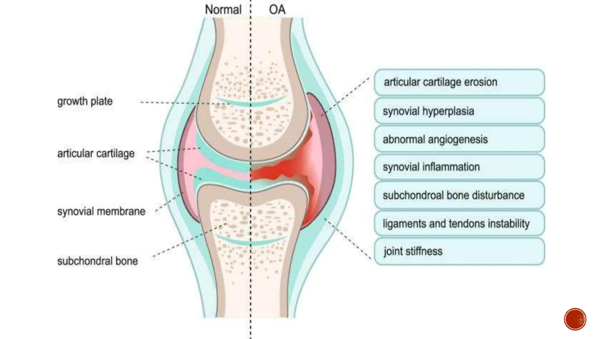 osteoarthritis.ppt easy way to prepared. | PPTX | Bone and Joint Conditions | Diseases and ...