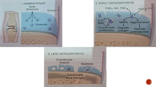 osteoarthritis.ppt easy way to prepared. | PPTX | Bone and Joint Conditions | Diseases and ...