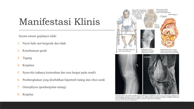 Materi kedokteran ostheoarthritis adalah peradangan pada sendi lutut | PPT