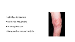 Osteoarthritis (Nutshell) | PPTX