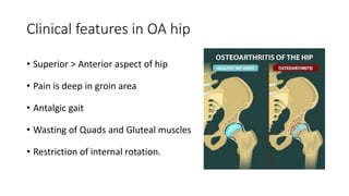 Osteoarthritis (Nutshell) | PPTX