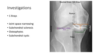 Osteoarthritis (Nutshell) | PPTX