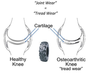 Osteoarthritis patient-education | PPT