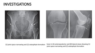 Osteoarthritis - primary and secondary osteoarthritis - AMON_013754.pptx