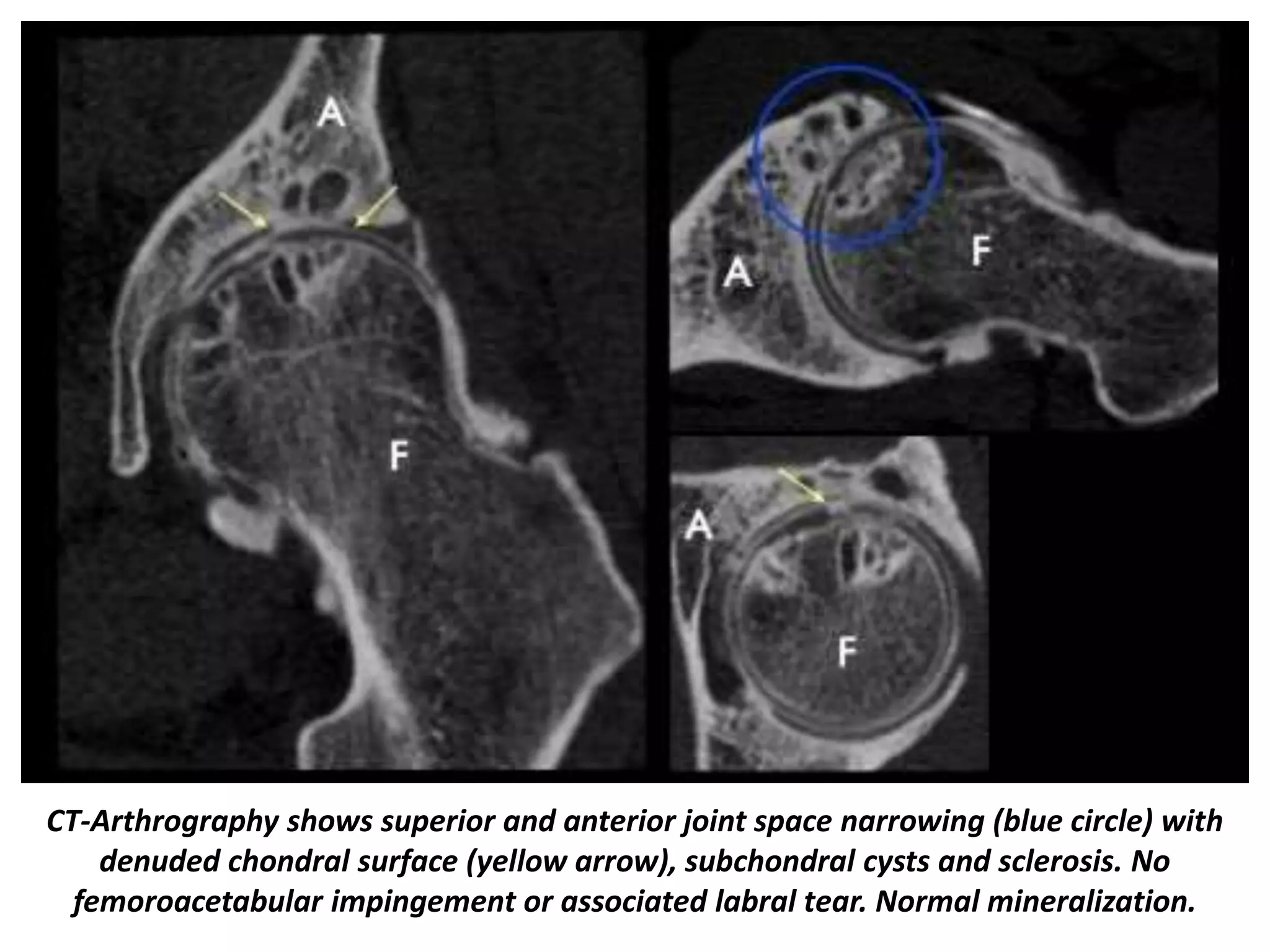 Osteoarthritis and Rheumatoid Arthritis | PPTX