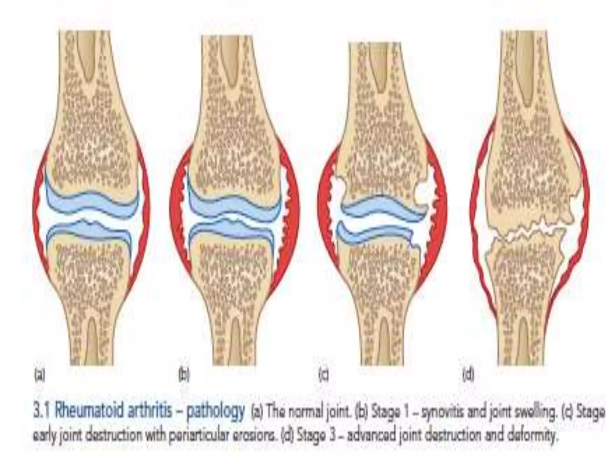 Osteoarthritis and Rheumatoid Arthritis | PPTX