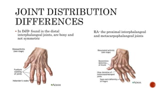 Osteoarthritis and rheumatoid arthritis | PPTX