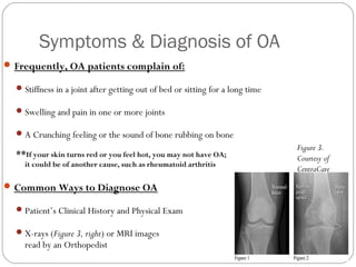 Osteoarthritis and total joint replacement.ppt (1) | PPT