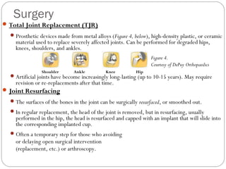 Osteoarthritis and total joint replacement.ppt (1) | PPT
