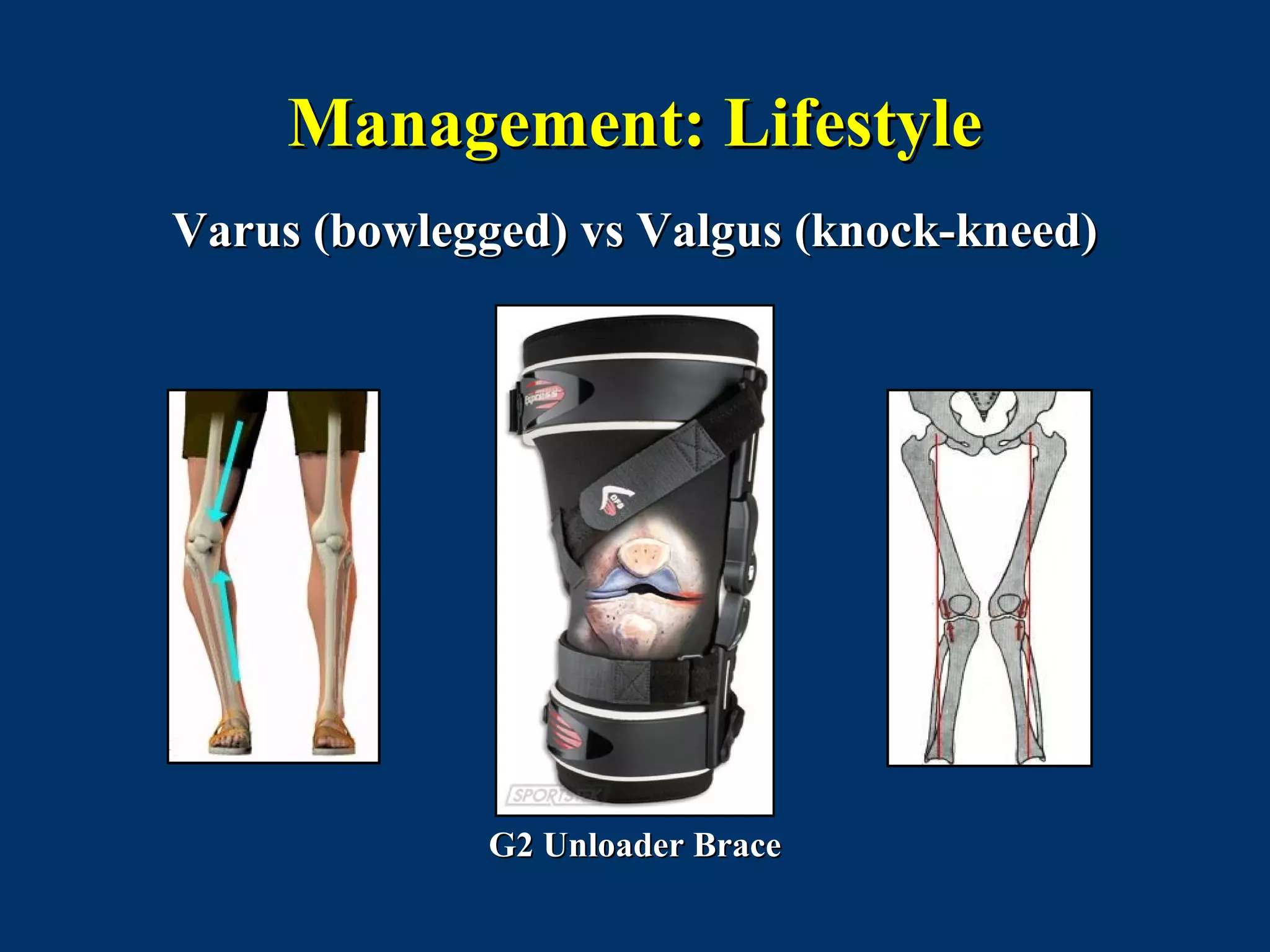 Osteoarthritis Diagnosis and Treatment | PPT