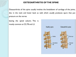 OSTEOARTHRITIS OF THE KNEE, HANDS, PELVIC AND SPINE (VERTEBRAL COLUMN ...
