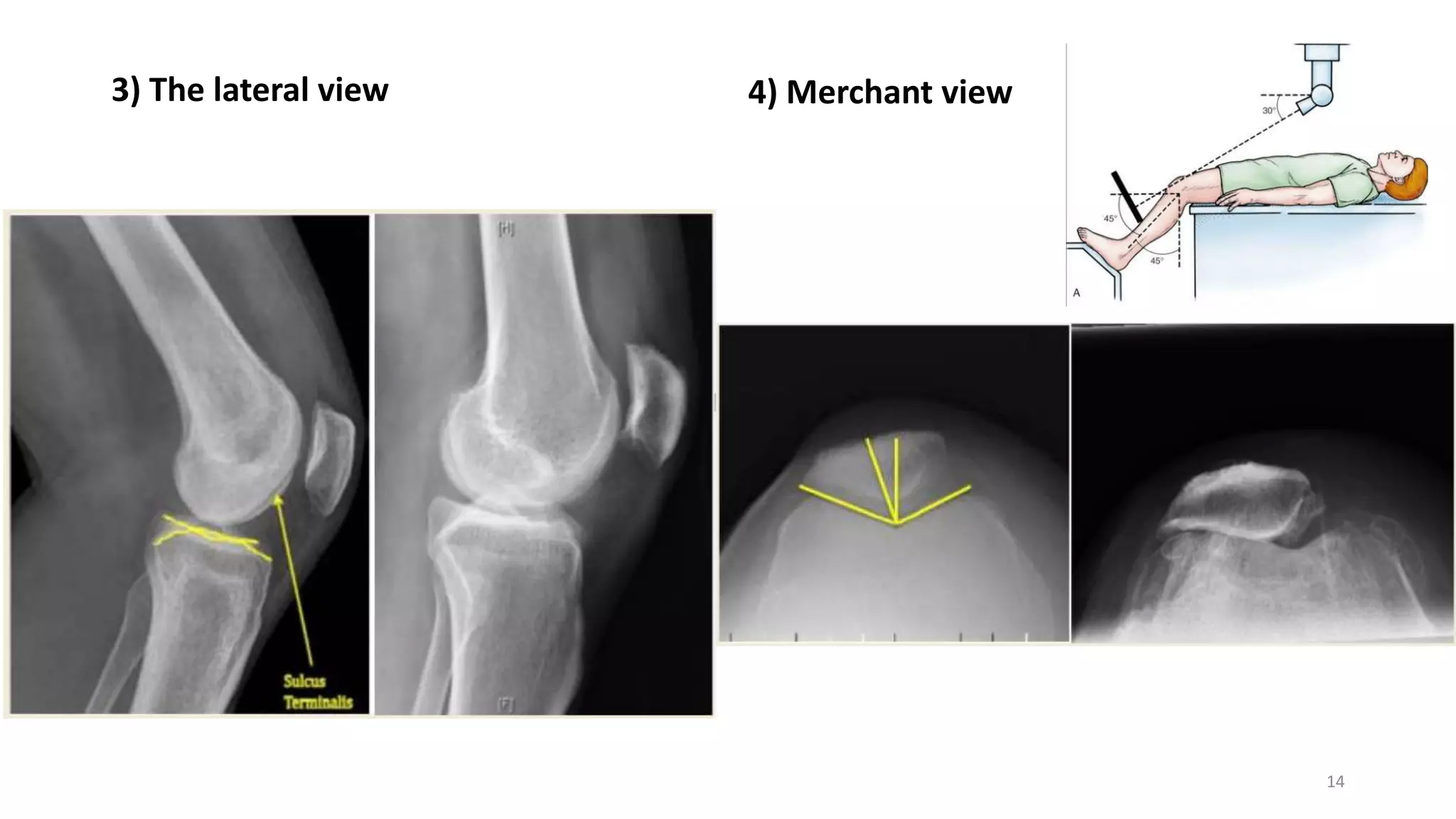 Osteoarthritis – Knee | PPTX