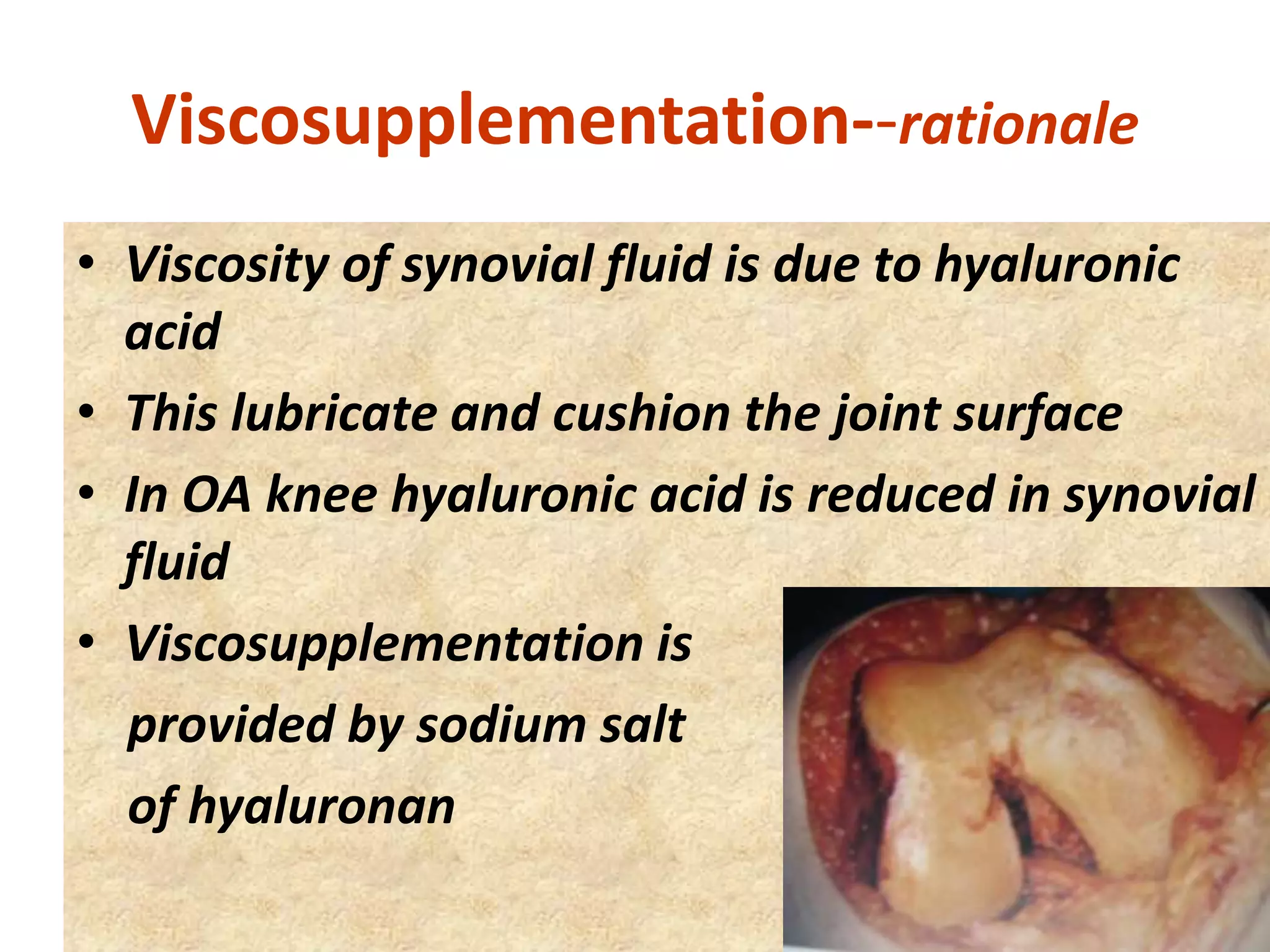 Osteoarthritis knee joint preservation options -dr mohamed ashraf,hod ...