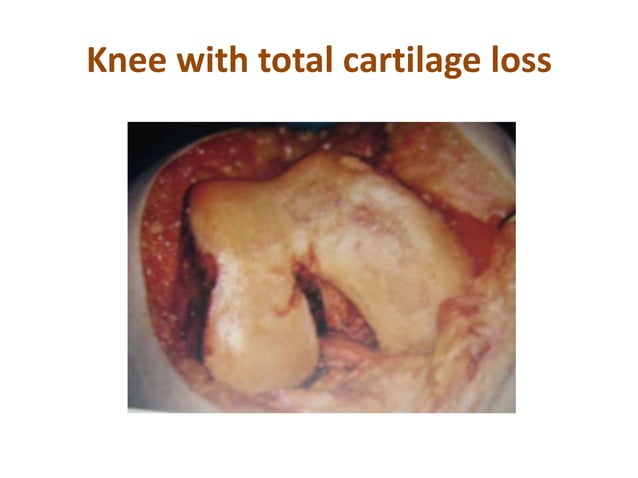 Osteoarthritis knee joint preservation options -dr mohamed ashraf,hod ...