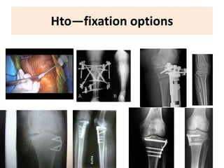 Osteoarthritis knee joint preservation options -dr mohamed ashraf,hod ...