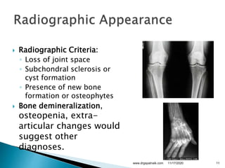 Osteoarthritis lecture | PPT