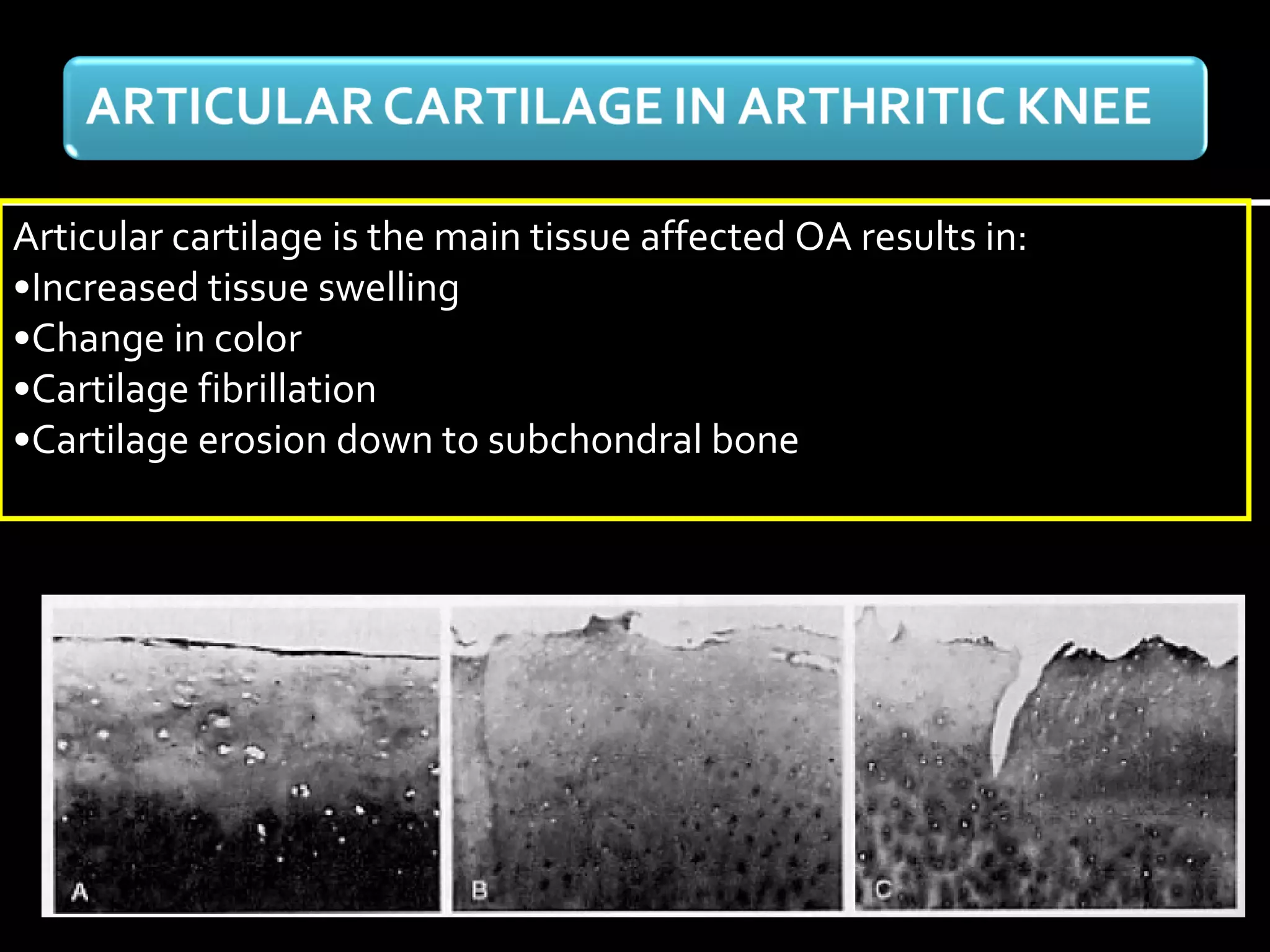 Osteoarthritis management | PPT