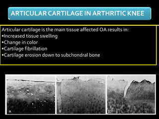 Osteoarthritis management | PPT