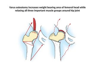 Osteoarthritis of hip in orthoapedics.pptx