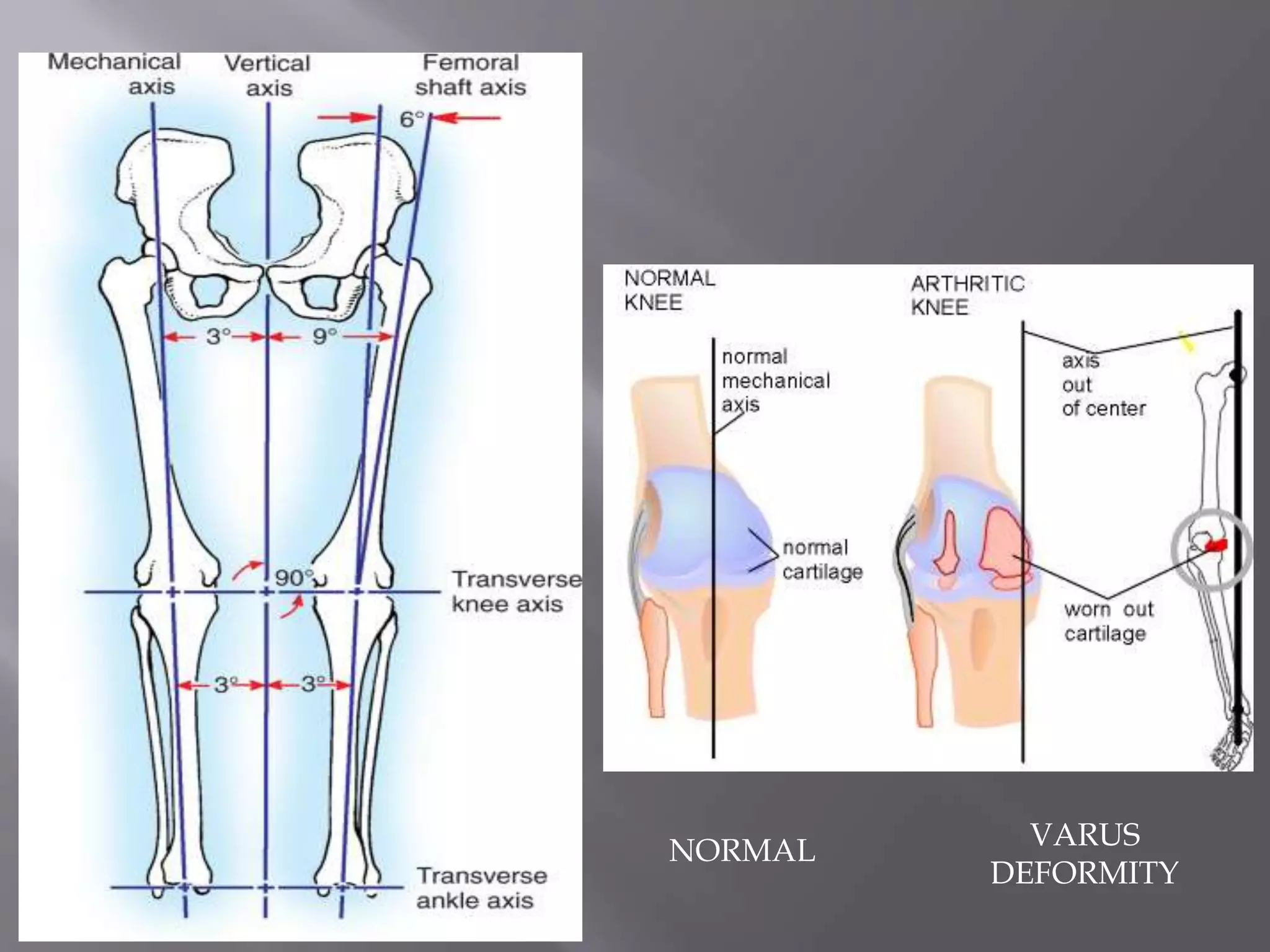 Osteoarthritis of Knee Joint | PPTX