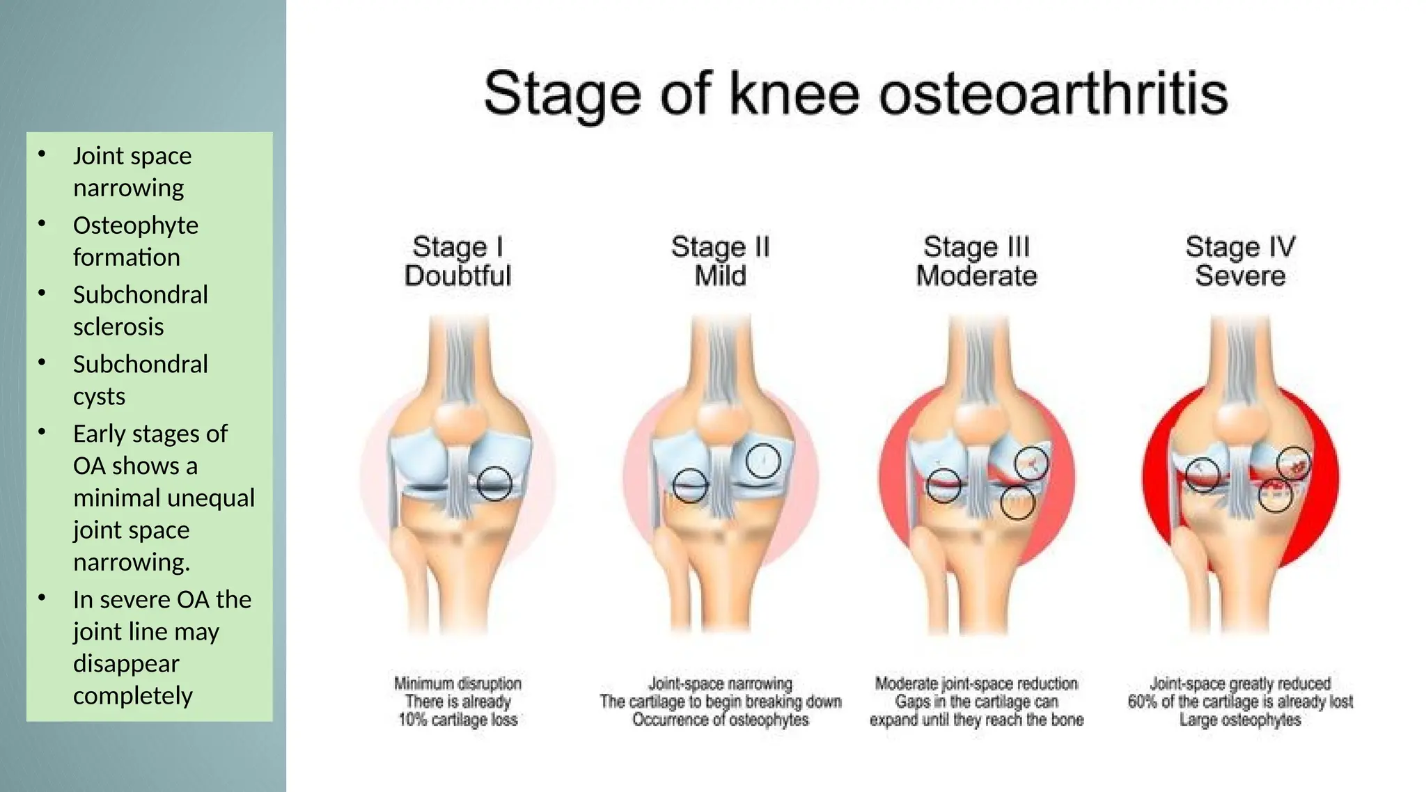 osteoarthritis of the knee and stages(1).pptx
