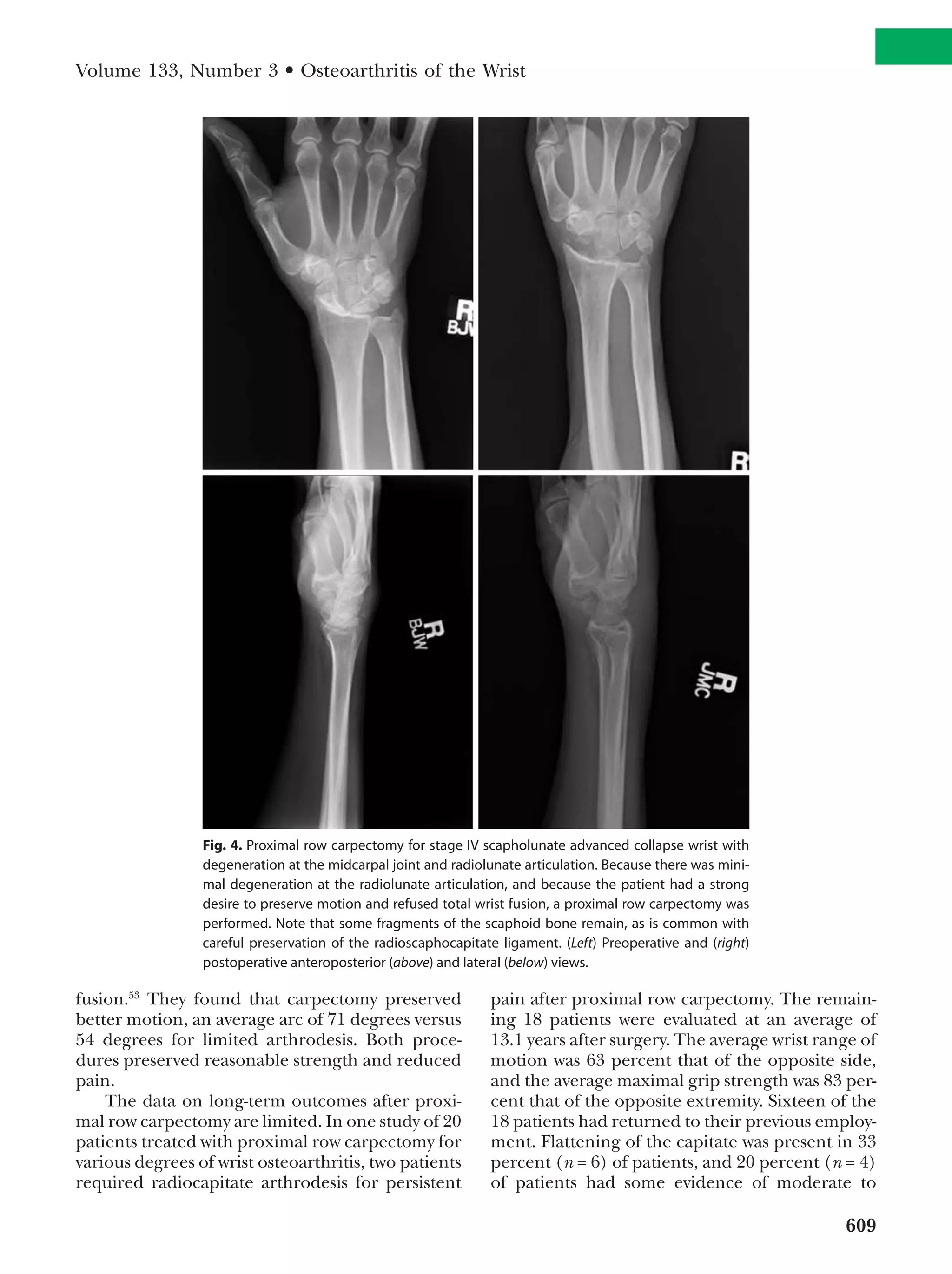 Osteoarthritis of the_wrist from Mayo Clinic | PDF