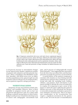 Osteoarthritis of the_wrist from Mayo Clinic | PDF