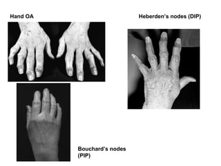 Osteoarthritis Diagnosis and management | PPT