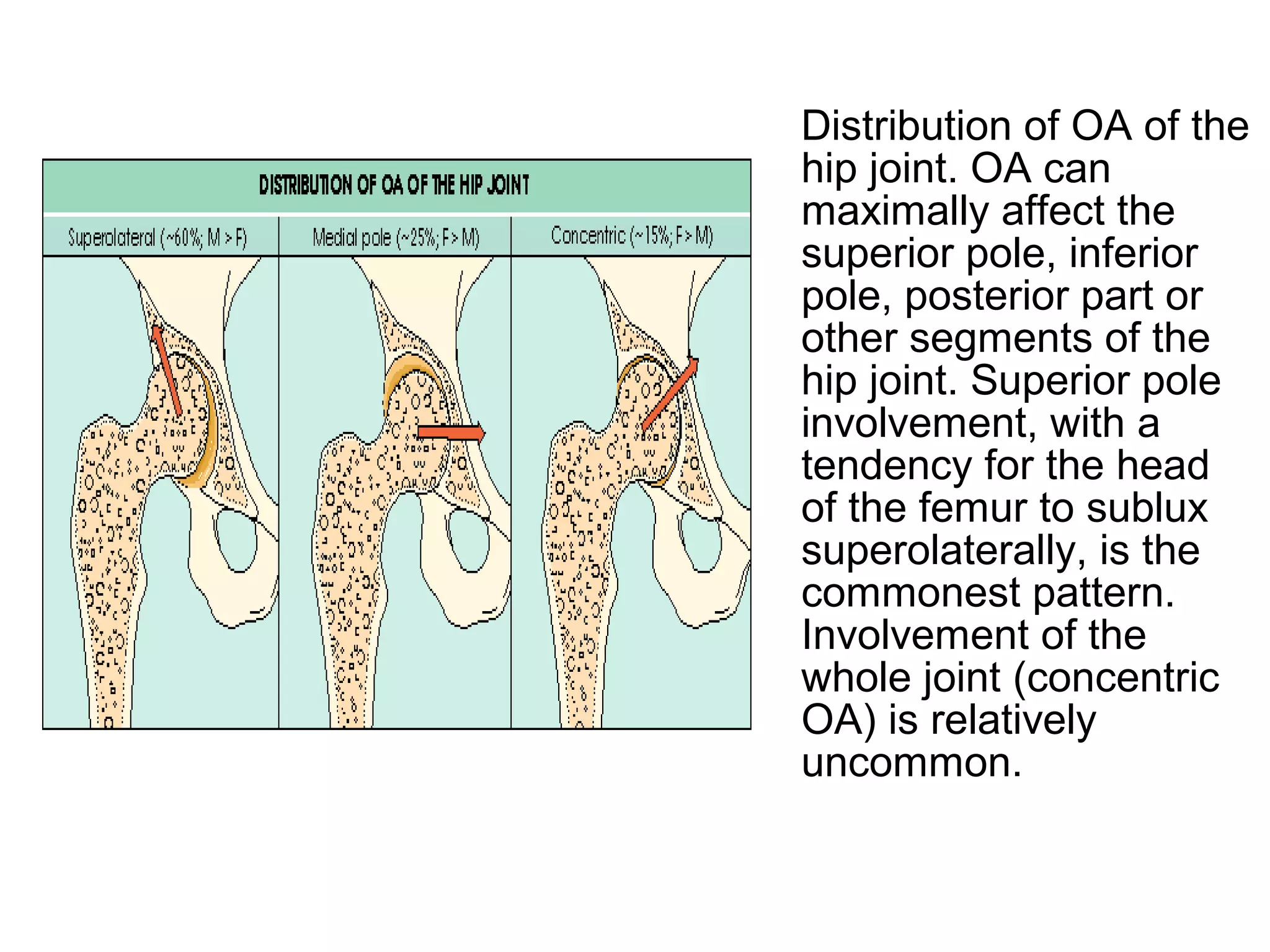 Osteoarthritis ppt | PPT