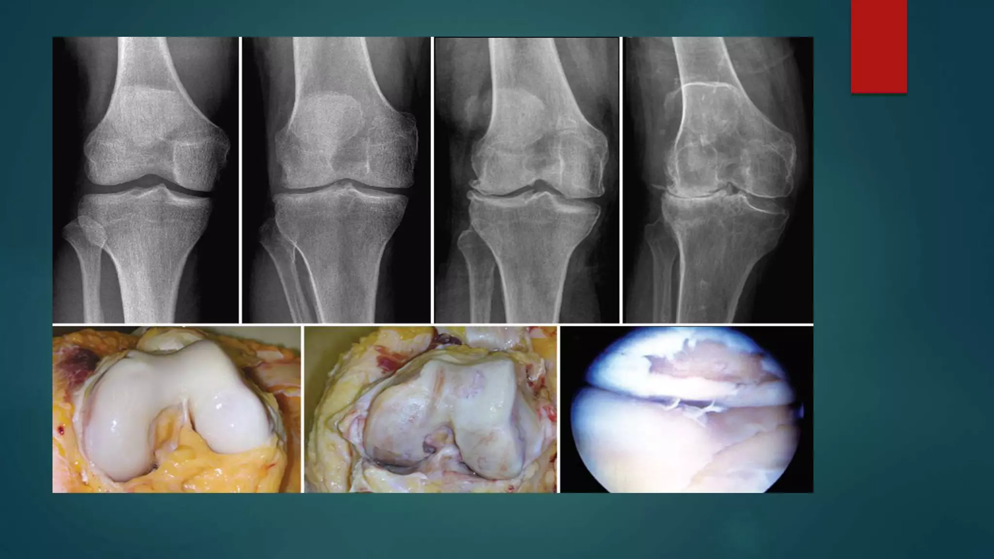 Osteoarthritis Ppt Pptx