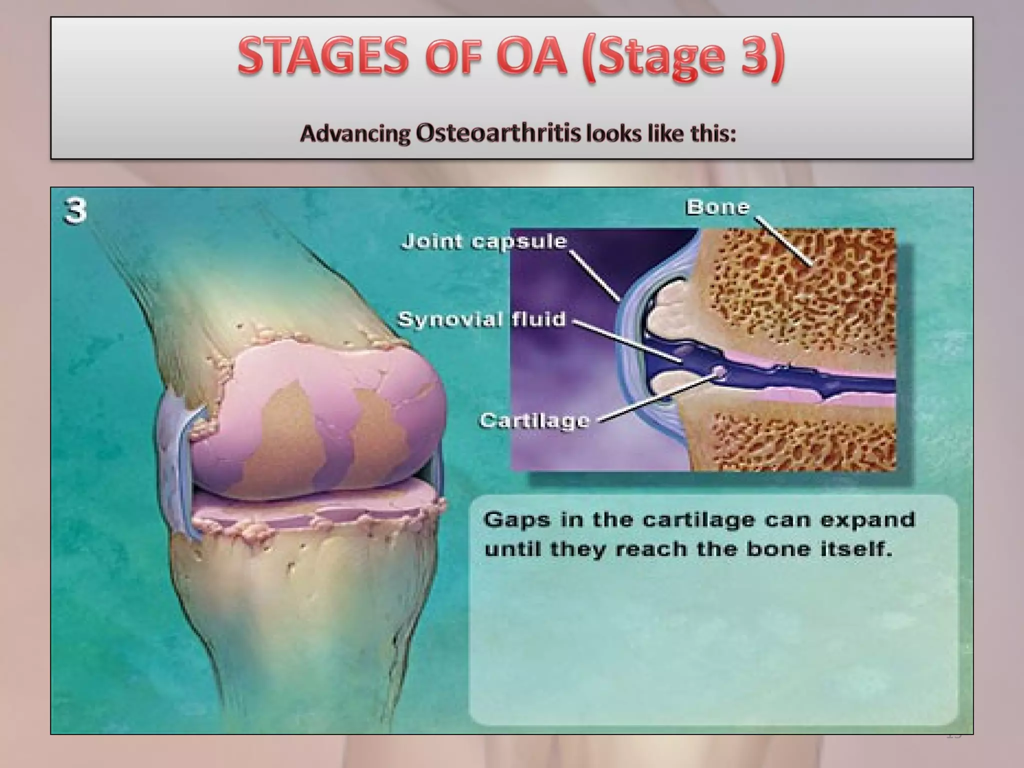Osteoarthritis pathophysiology & updated management | PPT