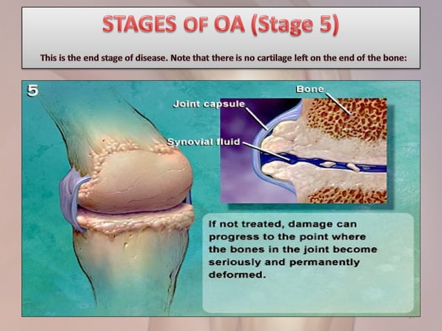 Osteoarthritis pathophysiology & updated management | PPT | Bone and ...
