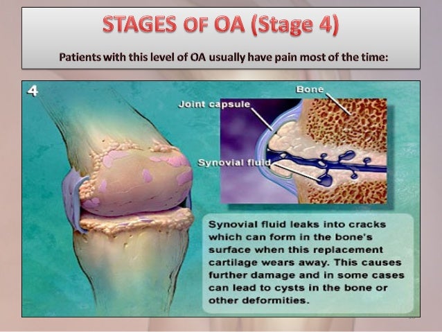 Osteoarthritis pathophysiology & updated management