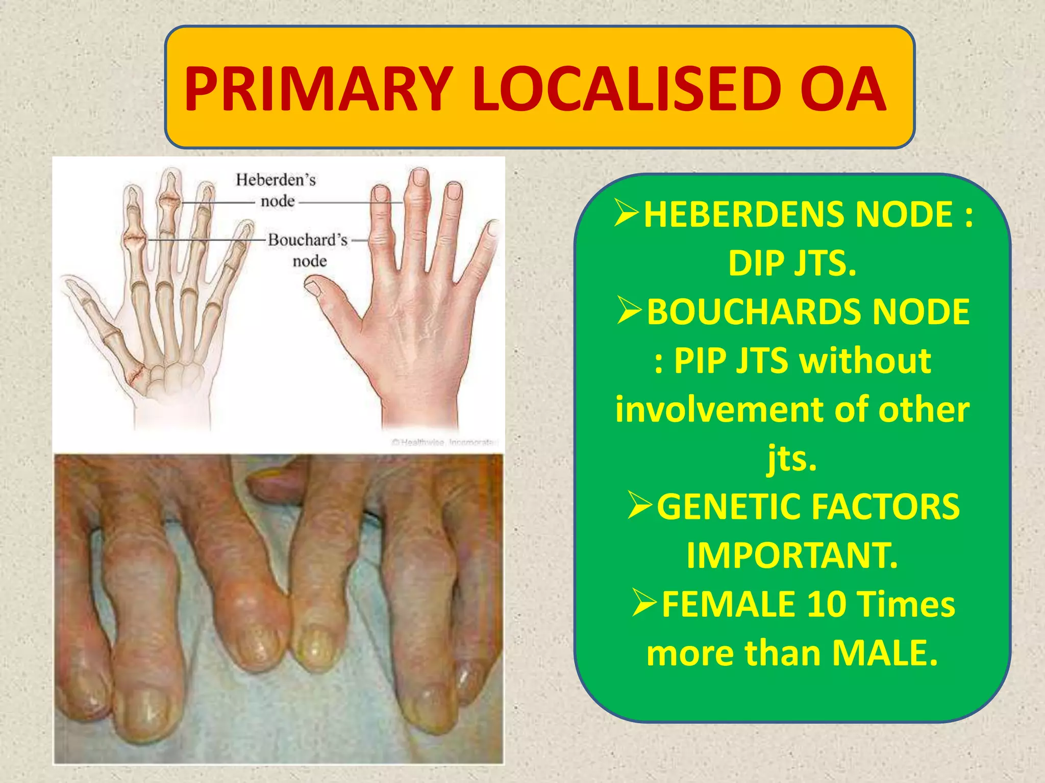 Osteoarthrosis,ppt | PPTX