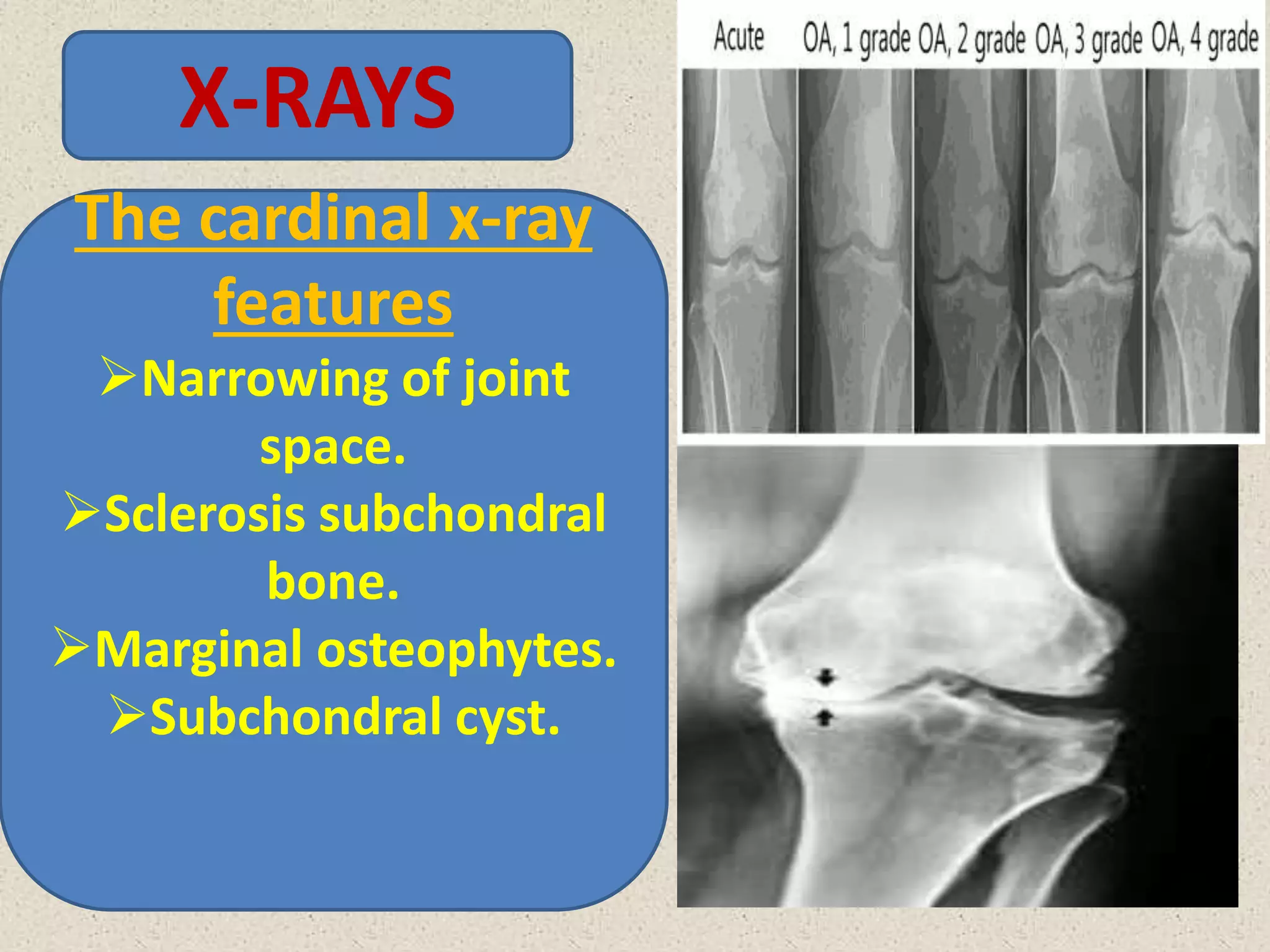 Osteoarthrosis,ppt | PPTX