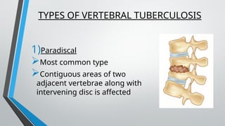 Osteoarticular TB Seminar by Abhilash Nair | PPT