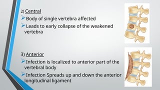 Osteoarticular TB Seminar by Abhilash Nair | PPT