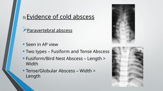 Osteoarticular TB Seminar by Abhilash Nair | PPT