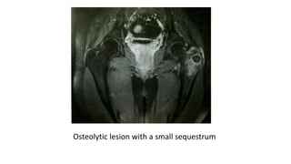 Osteoarticular tuberculosis | PPTX