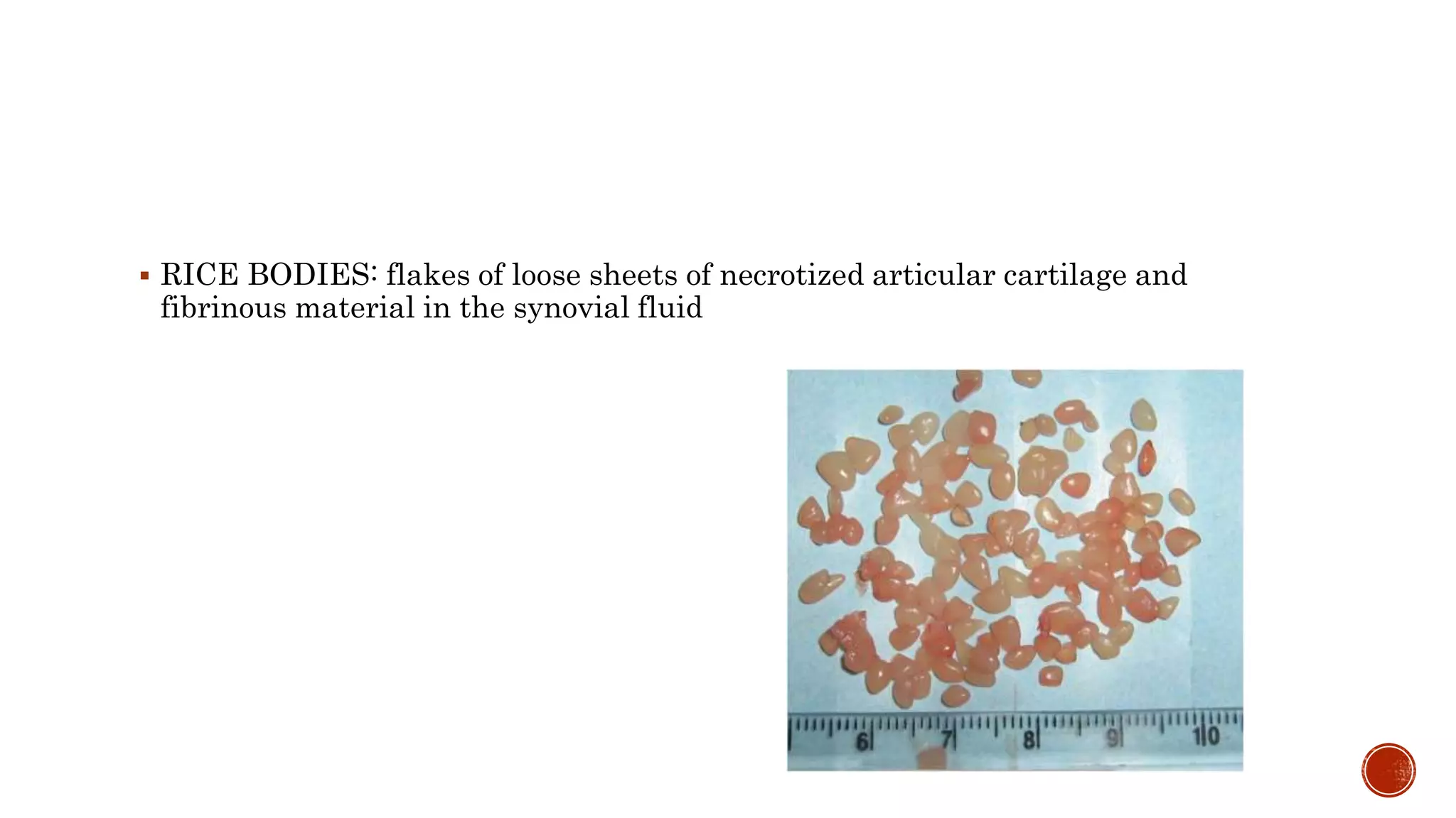 Osteoarticular tuberculosis | PPTX