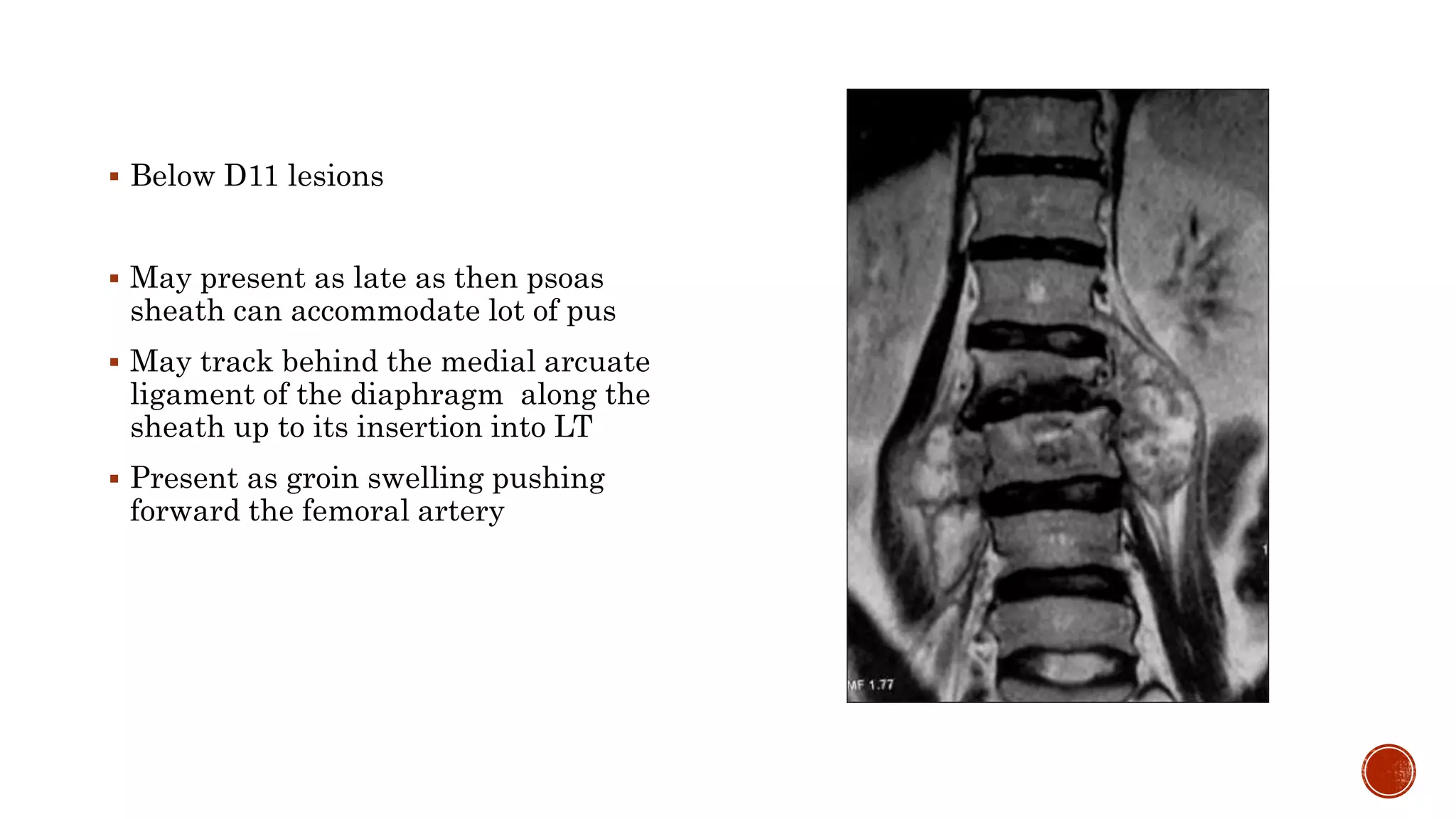 Osteoarticular tuberculosis | PPTX