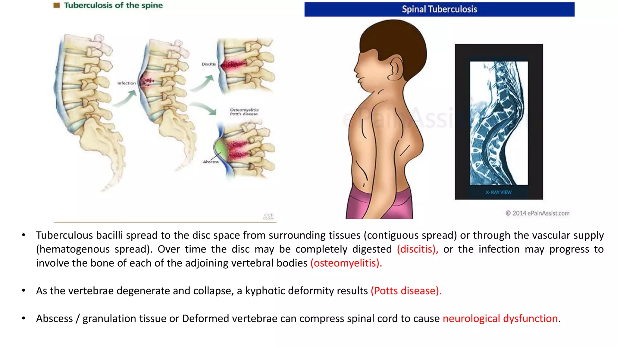 Osteoarticular tuberculosis | PPTX