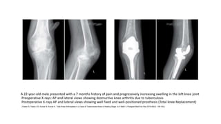 Osteoarticular tuberculosis | PPTX