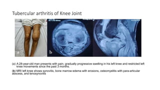 Osteoarticular tuberculosis | PPTX