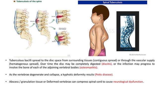 Osteoarticular tuberculosis | PPTX | Bone and Joint Conditions ...