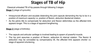 Osteoarticular Tuberculosis knee and spine | PPTX