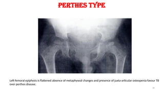 Osteoarticular Tuberculosis knee and spine | PPTX